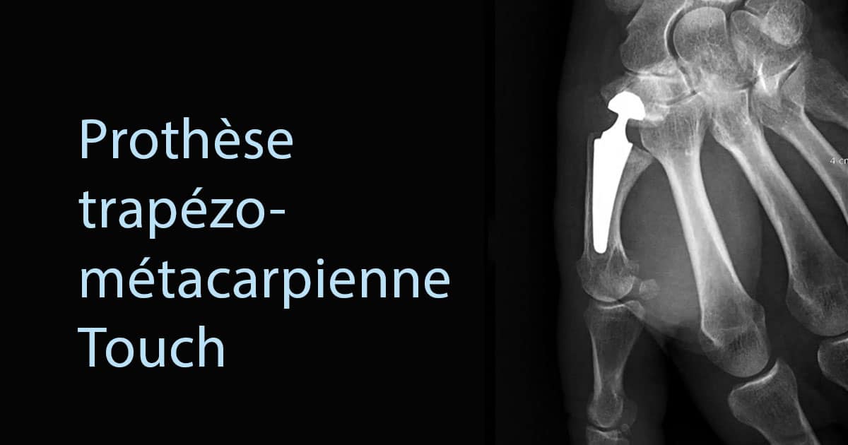 Prothèse trapézo-métacarpienne Touch - IM2S