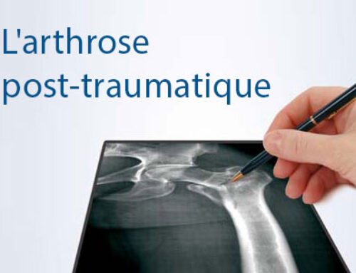 Main - fracture de doigt et phalange - IM2S