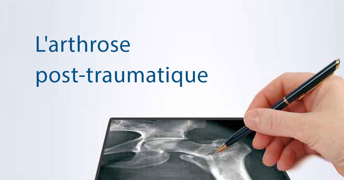L'arthrose post-traumatique - IM2S