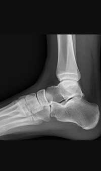 Entorse de cheville - IM2S